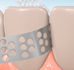 Invisalign Update What Is Ipr Beauty Skeptic